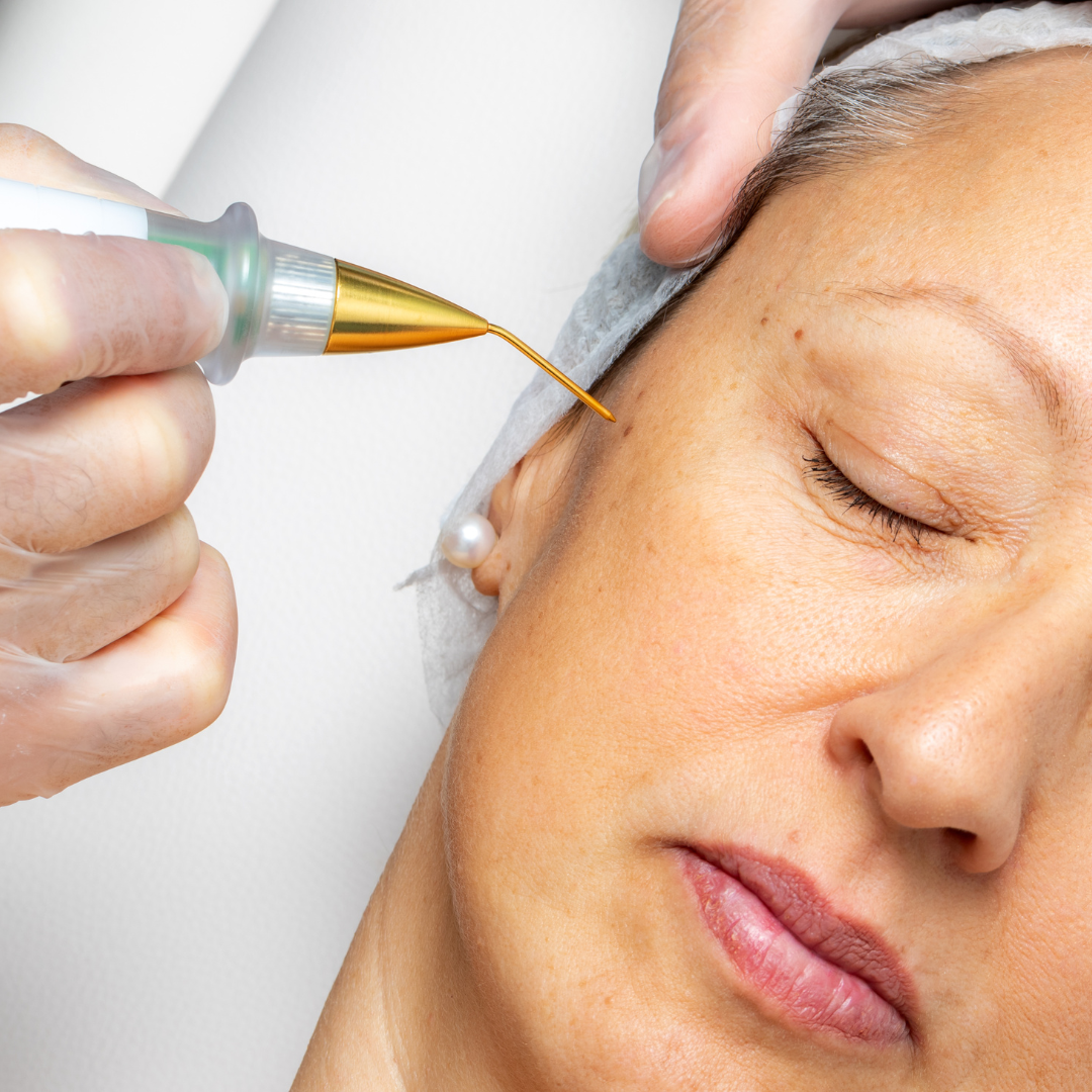 Plasma Fibroblast Training Course – Dermaskin Training